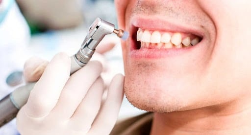 Igienizare dentara profesionala: Consultatie +Detartraj ultrasonic+ ...